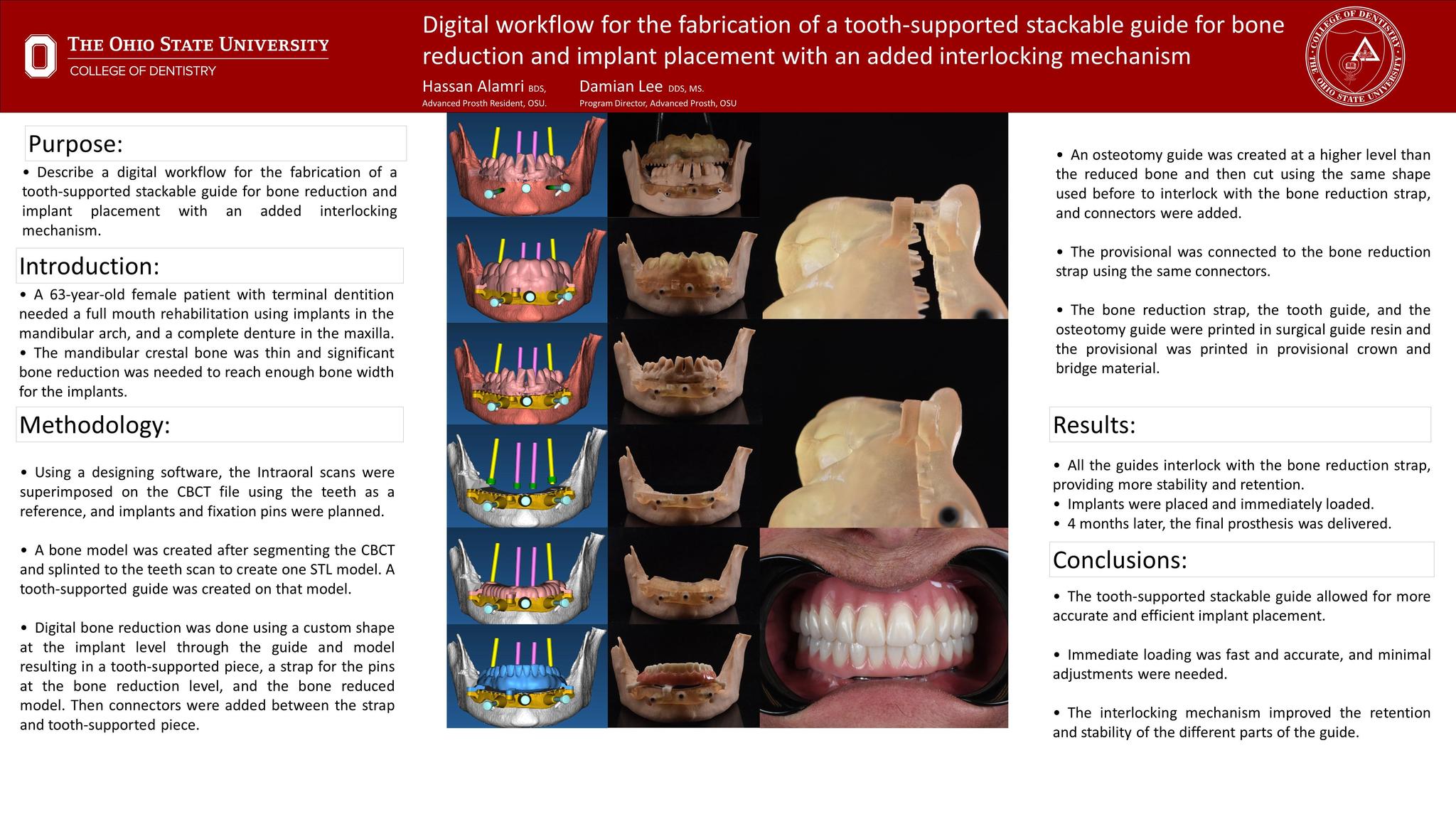 44. Digital workflow for the fabrication of a tooth-supported stackable ...