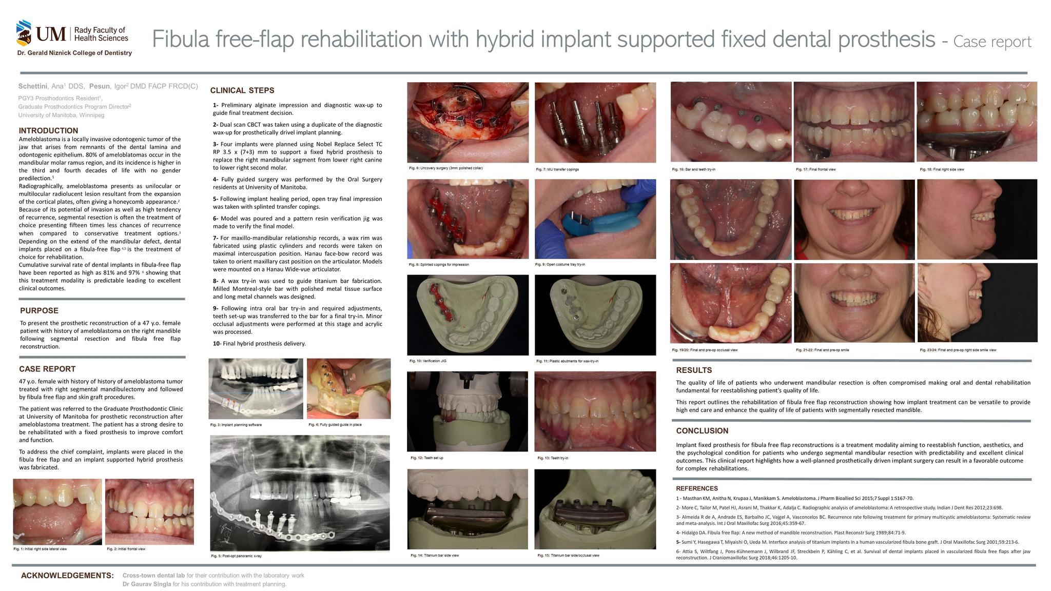 30. Fibula free-flap rehabilitation with hybrid implant supported fixed ...