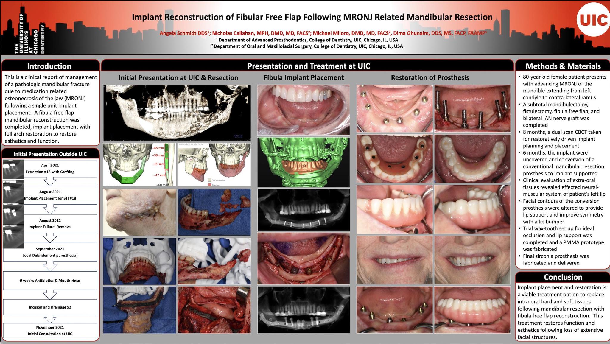 64. Implant reconstruction of fibula free flap following MRONJ related ...