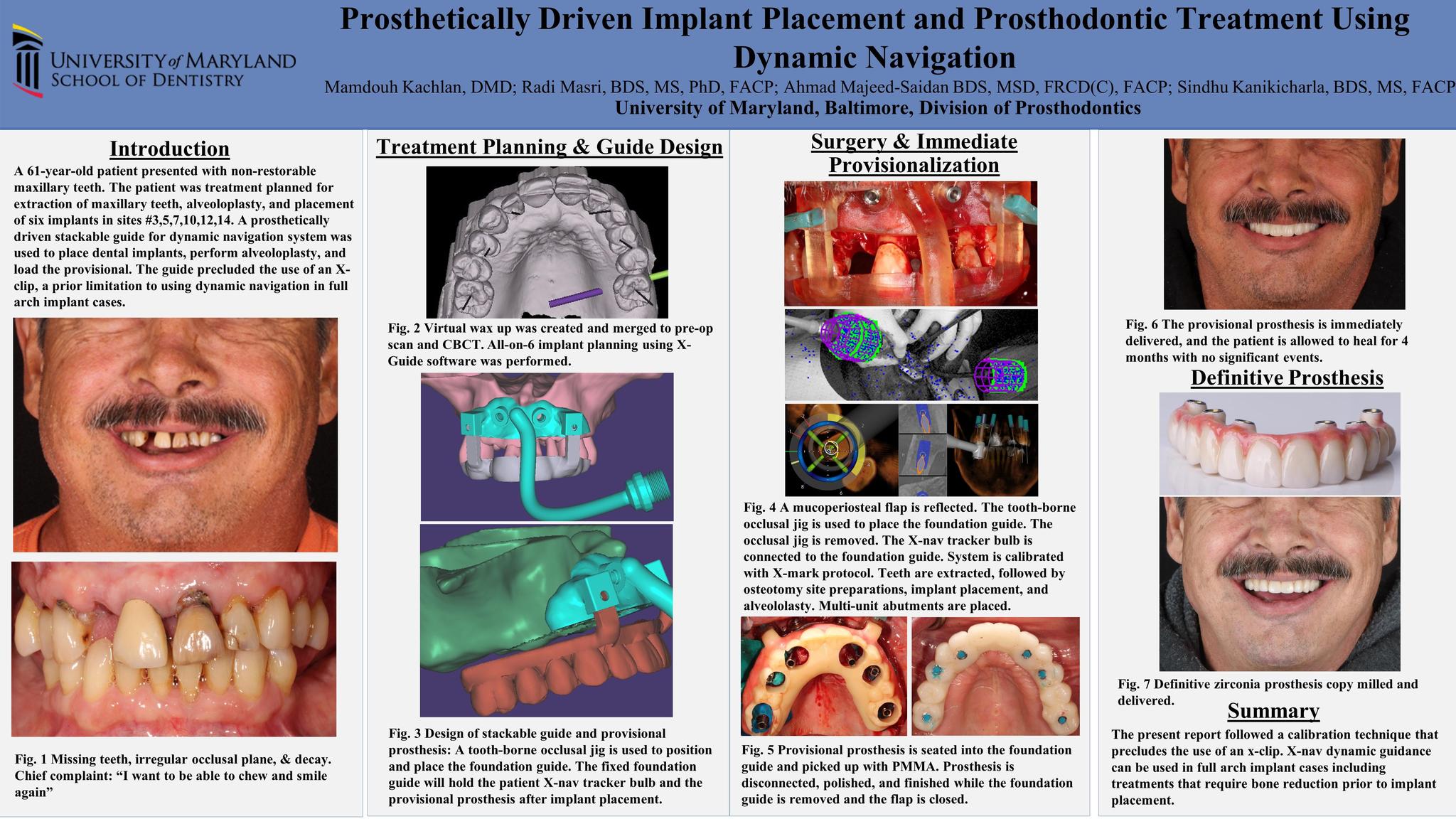 46. Prosthetically driven implant placement and prosthodontic treatment ...