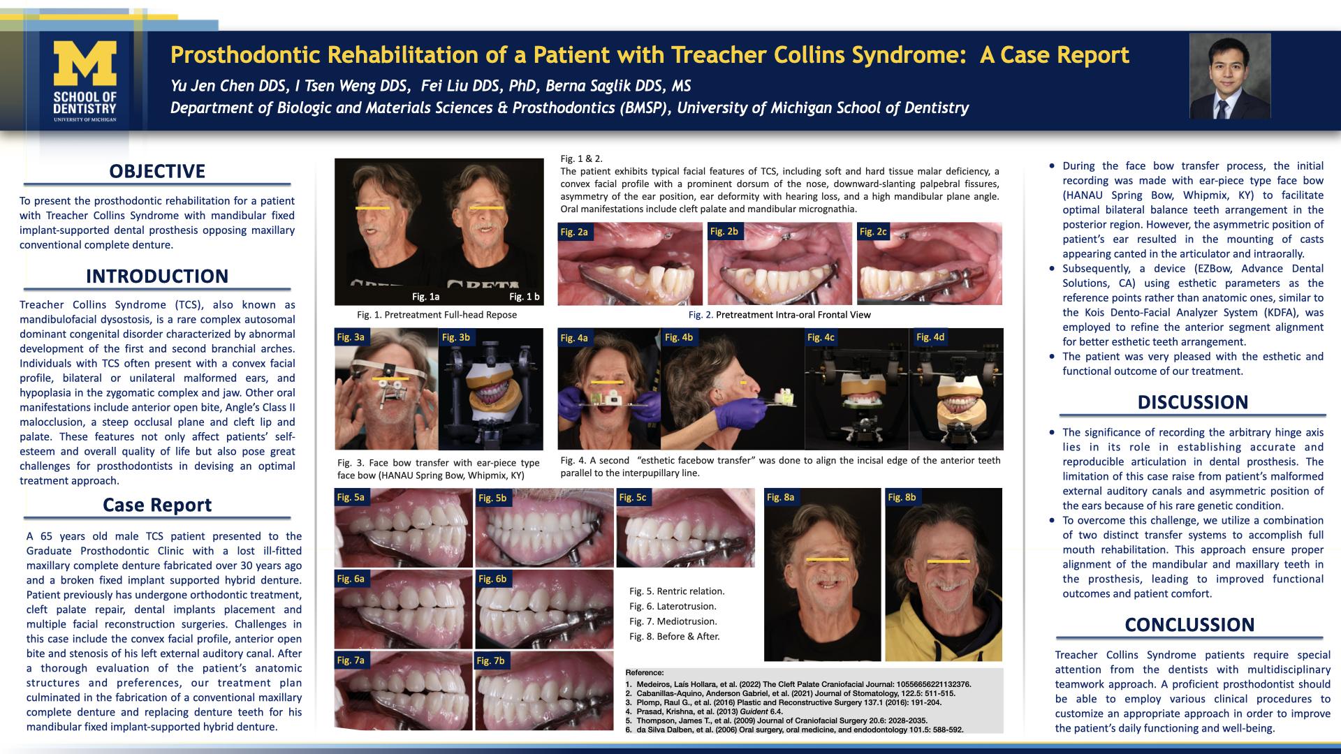 39. Prosthodontic Rehabilitation of a Patient with Treacher Collins ...