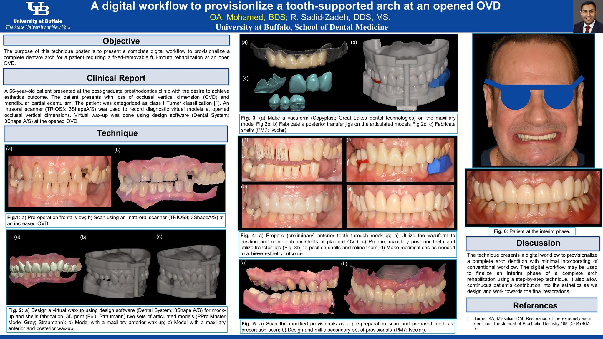 4. A digital workflow to provisionlize a tooth-supported arch at an ...