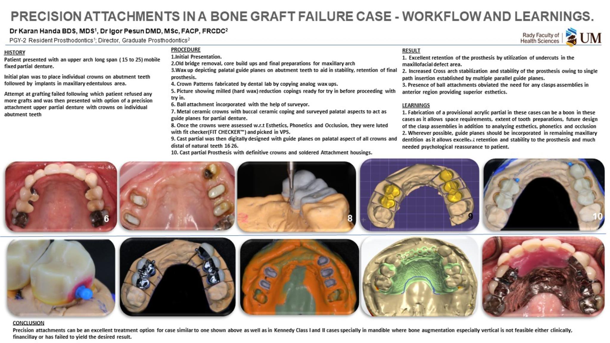 7. Precision attachments to the rescue in bone graft failure cases ...
