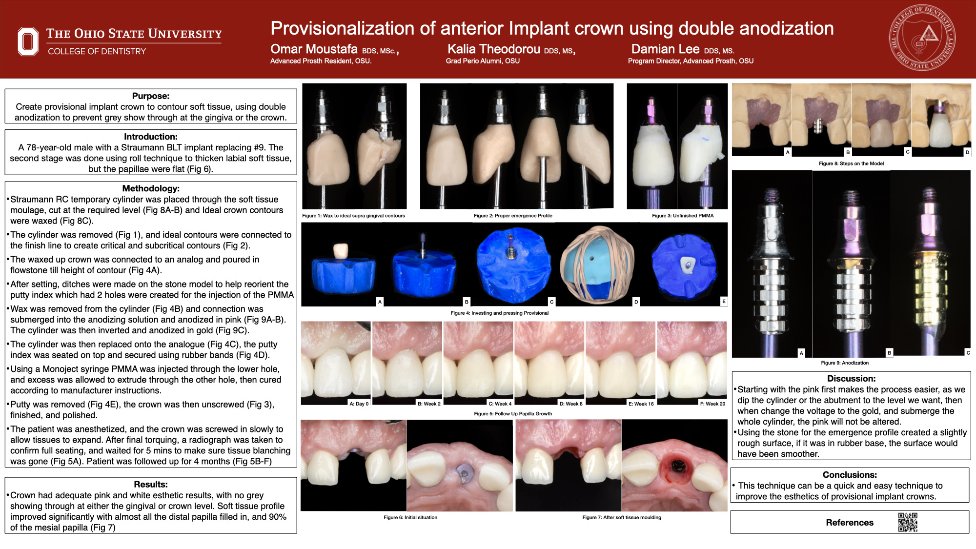17. Step by step technique for creating an anterior implant provisional ...