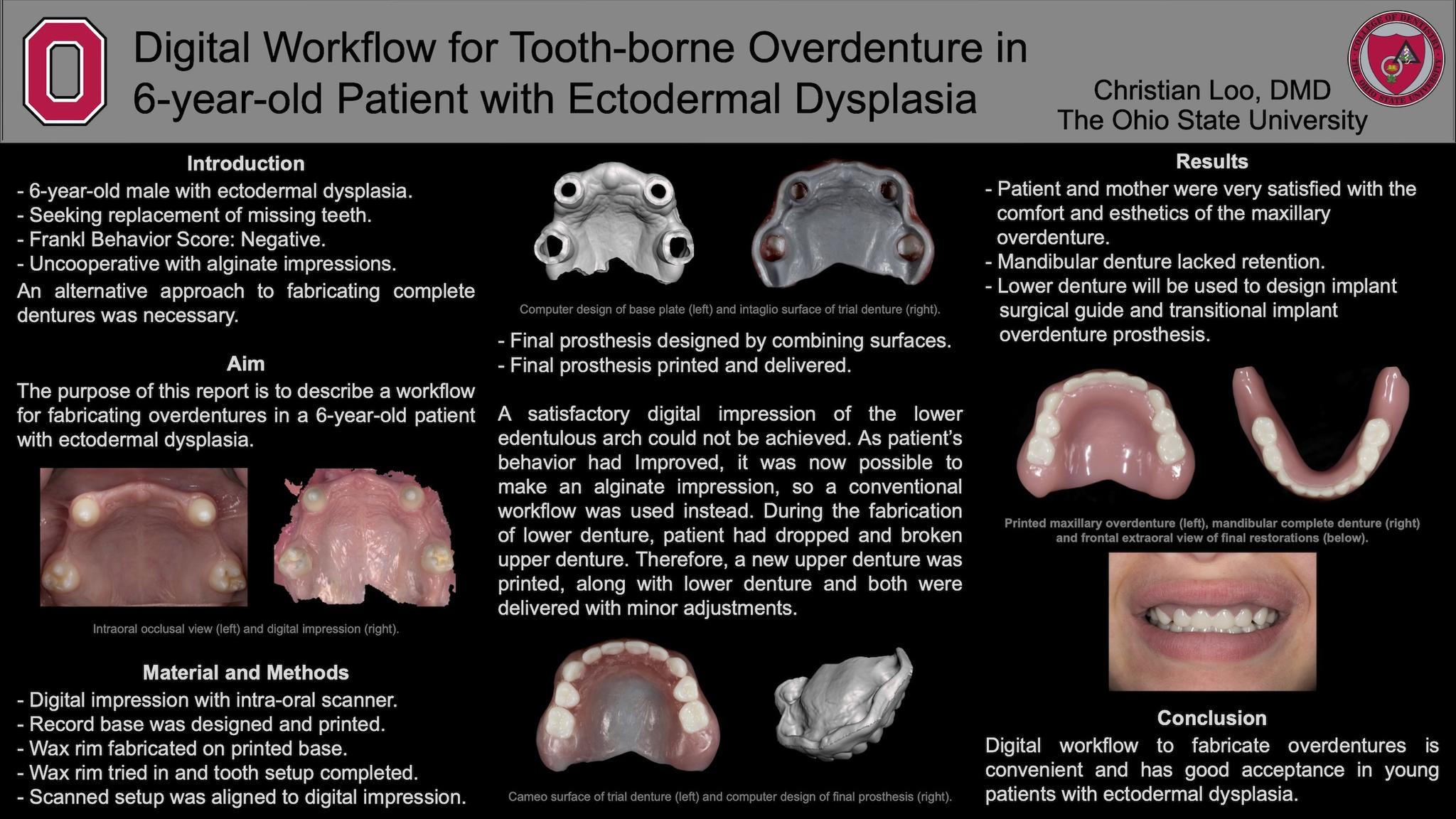 Digital Workflow for Tooth-borne Overdenture in 6-year-old Patient with ...