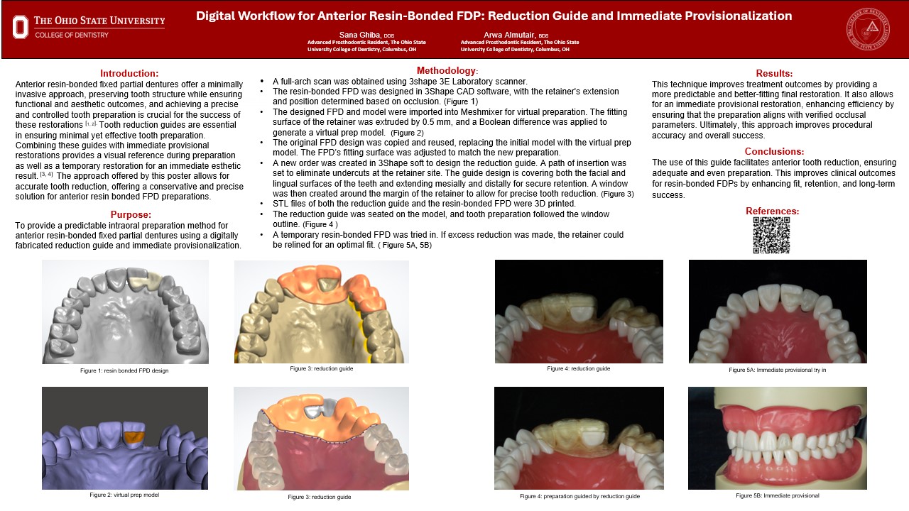 Digital Workflow for an Anterior Resin Bonded FDP Reduction Guide